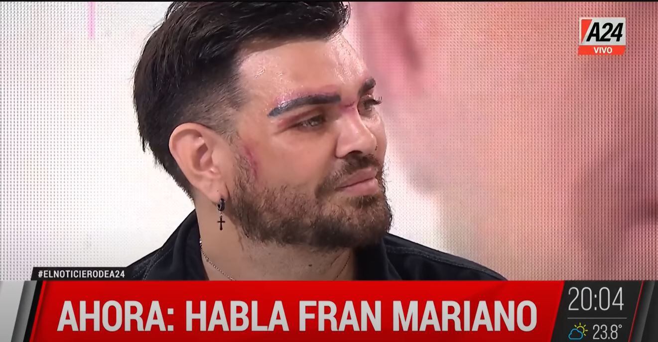 Fran Mariano: Hombre argentino acusa que quedó desfigurado por malas ...